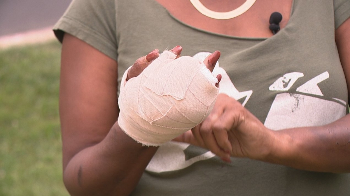 Woman Says Neighbor Bit Her Finger Off During Robbery
